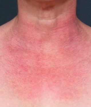 Acne Rosacea Chest