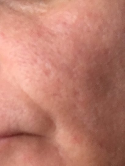 40s Acne Scars - Tried Lasers, Subcision and Punch Excision - Acne ...