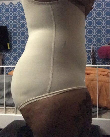 Tumescent Lipo on Flanks, Bra Strap, Lower and Upper Abdomen ...