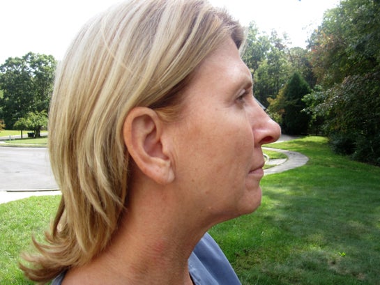 Full Facelift for This 55 Year Old Youngster!! - Facelift review - RealSelf