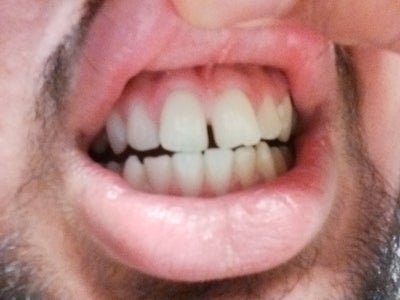 I have buck teeth that are driving me nuts. What would be the best ...