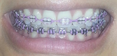 Currently in Braces After a Year - Brampton, ON - Braces review - RealSelf