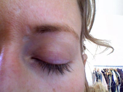 3-year Old Shingles Scars on Eyebrows. What Are My Options? (photo ...