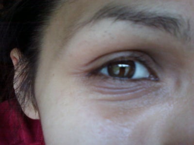 Can You Treat a Dennie Morgan Fold? Doctor Answers, Tips