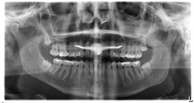 Bulimia Teeth. What to Do? (photo) Dentist Answers, Tips