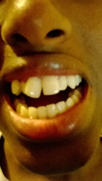 Bad teeth help? - Front buck teeth are both crooked and twisted (photos ...