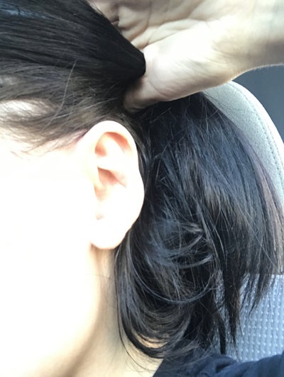 Botched Otoplasty Results - Ear Surgery review - RealSelf