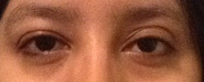Which eyelid is normal? My eyes don't look the same, but I don't know ...