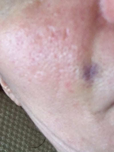 40s Acne Scars - Tried Lasers, Subcision and Punch Excision - Acne ...