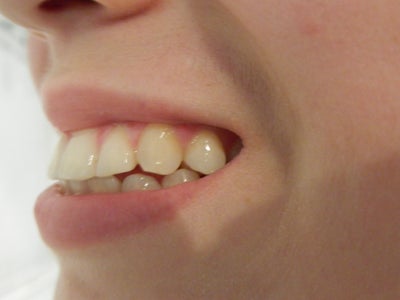 Been self conscious of my flared out teeth lately. Is there a way to ...