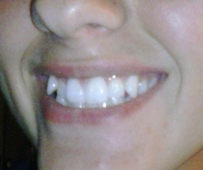 I Was Curious the Best Way to Fix my Snaggle Tooth Would Be? (photo ...