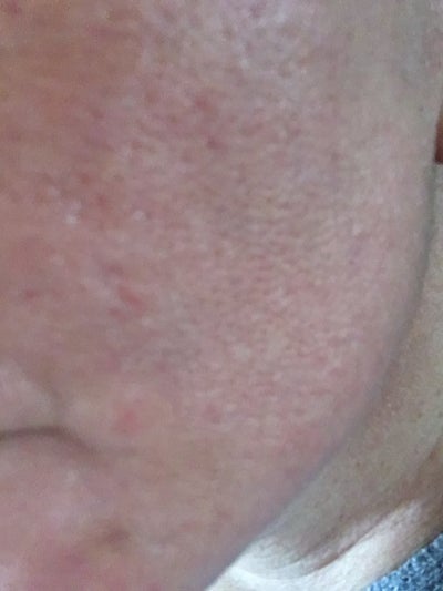 40s Acne Scars - Tried Lasers, Subcision and Punch Excision - Acne ...