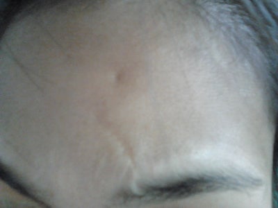 Long Indented Old Scar on Forehead. What Do You Recommend? (photo ...