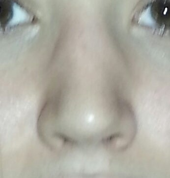 I have noticed some very disturbing bumps on my nose bridge and on its ...